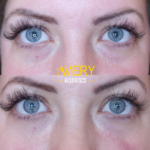 Cheek Enhancement | Avery Aesthetics Kent