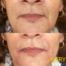 Cheek Enhancement | Avery Aesthetics Kent
