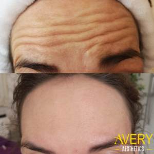 Cheek Enhancement | Avery Aesthetics Kent