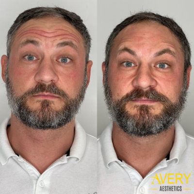 Lip Fillers | Avery Aesthetics Kent