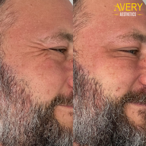 Lip Fillers | Avery Aesthetics Kent