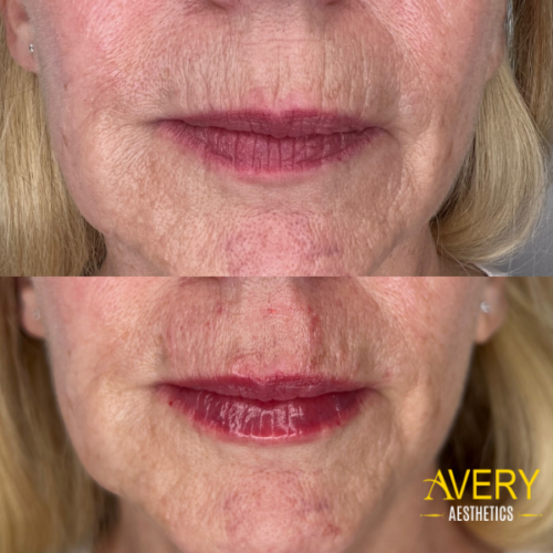 Lip Fillers | Avery Aesthetics Kent
