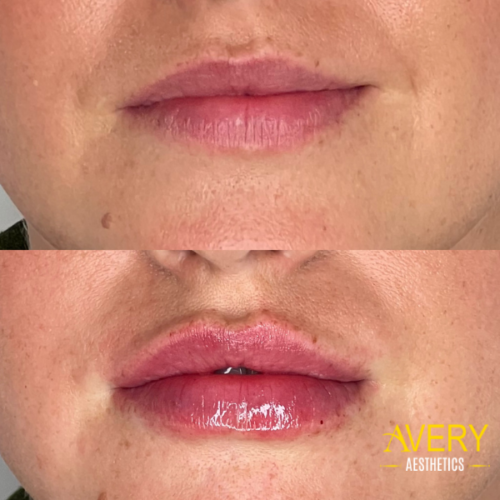 Lip Fillers | Avery Aesthetics Kent