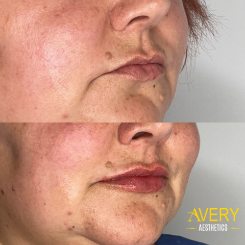 Lip Fillers | Avery Aesthetics Kent