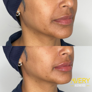 Cheek Enhancement | Avery Aesthetics Kent