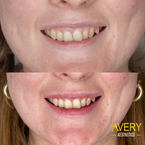 Lip Fillers | Avery Aesthetics Kent