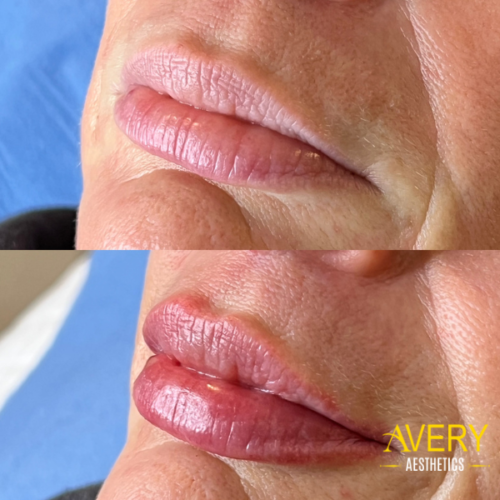 Lip Fillers | Avery Aesthetics Kent