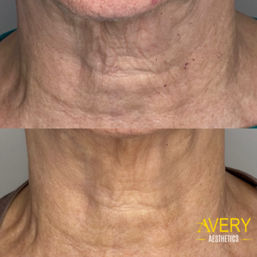 Lip Fillers | Avery Aesthetics Kent