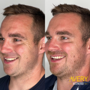 Cheek Enhancement | Avery Aesthetics Kent