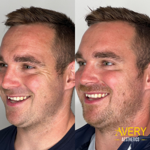Lip Fillers | Avery Aesthetics Kent