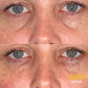 Cheek Enhancement | Avery Aesthetics Kent